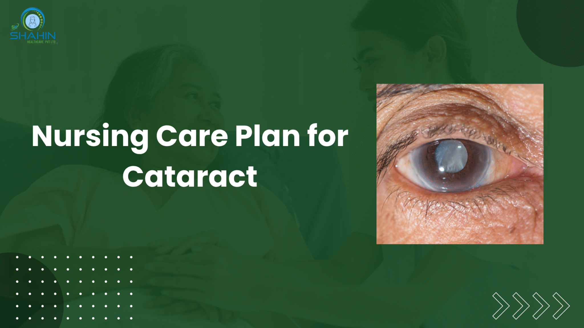 Nursing Care Plan for Cataract: An In-Depth Guide
